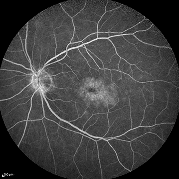 Macular Edema: Causes, Symptoms, & Treatment Options - Venice Retina
