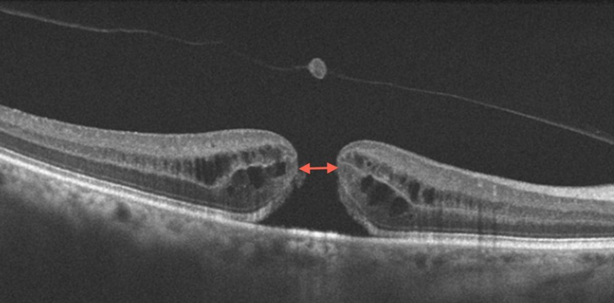 Retinal Membrane Peel: Effective Treatment for Macular Disorders at ...