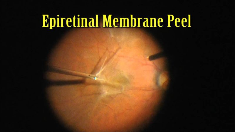 Retinal Membrane Peel: Effective Treatment for Macular Disorders at ...