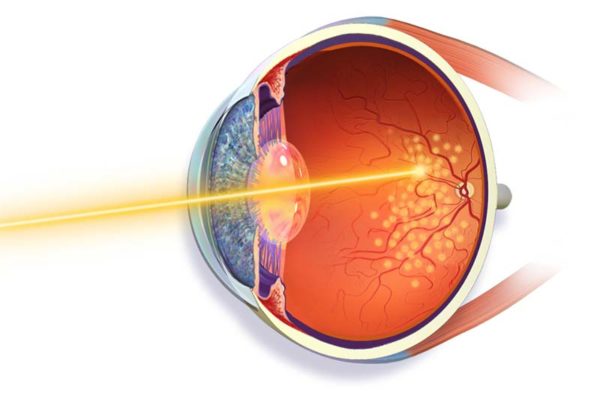 Retinal Laser Therapy | Retina Laser Treatments for Diabetes
